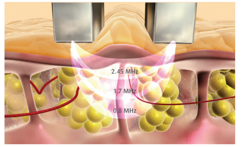 Viora ReactionTM - RF Device - Advance Dynamics